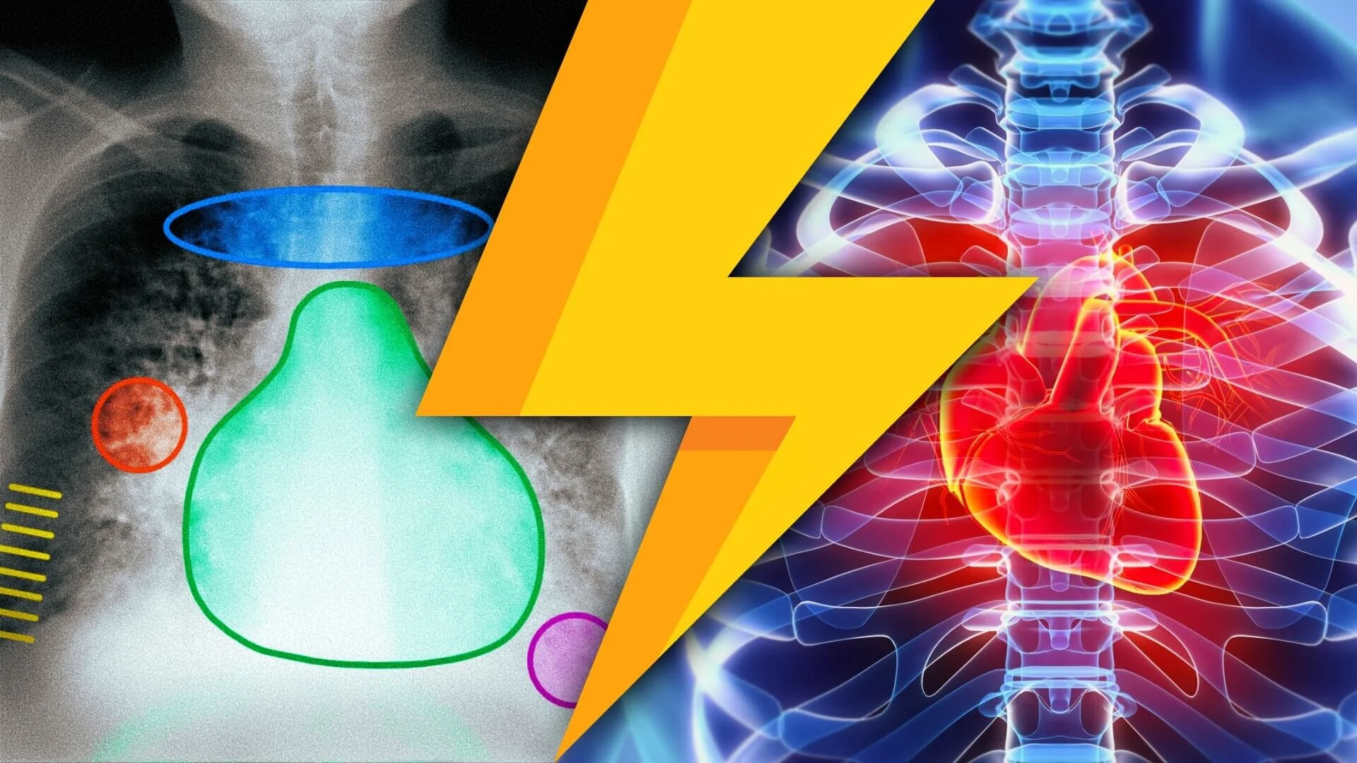 Acute Heart Failure Poster Medicine