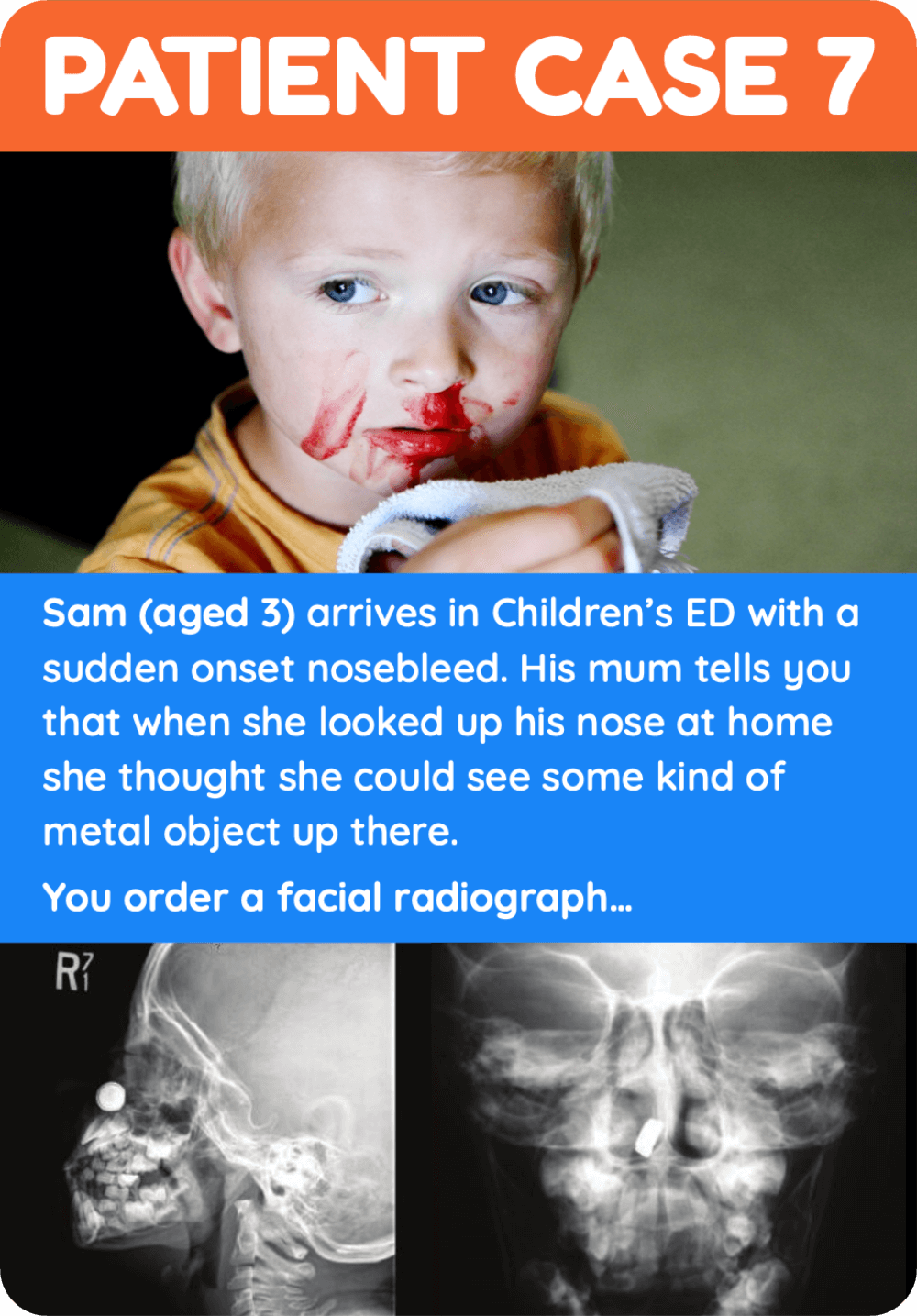 The Paediatric Foreign Body Game — EM3