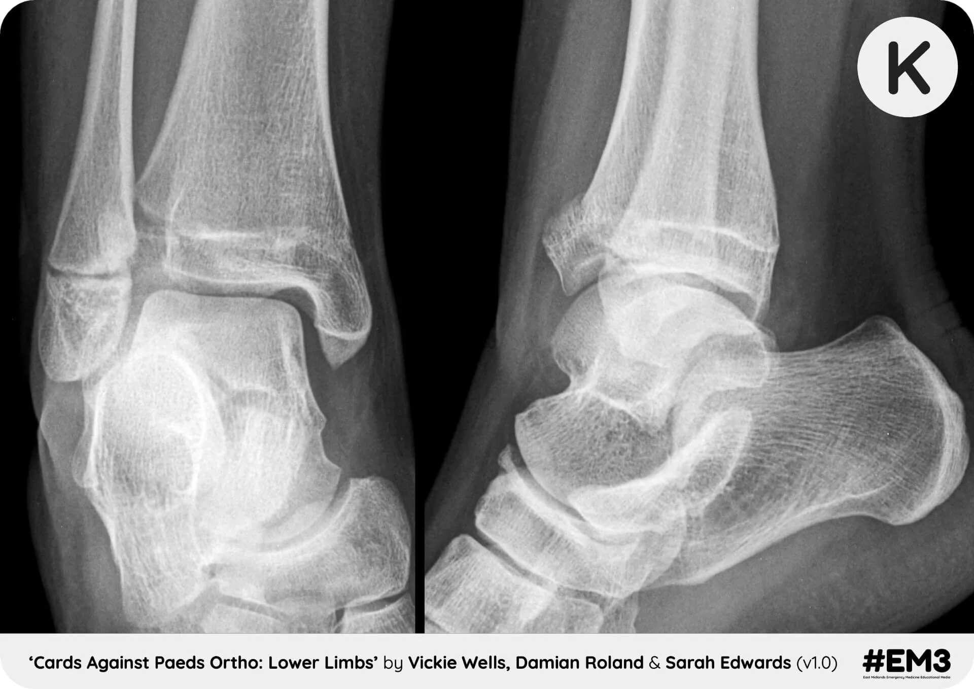 Cards Against Paediatric Orthopaedics (Lower Limbs) — EM3