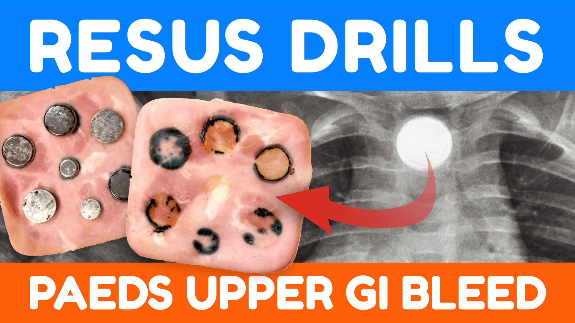 Resus Drills: Paeds Upper GI Bleed — EM3