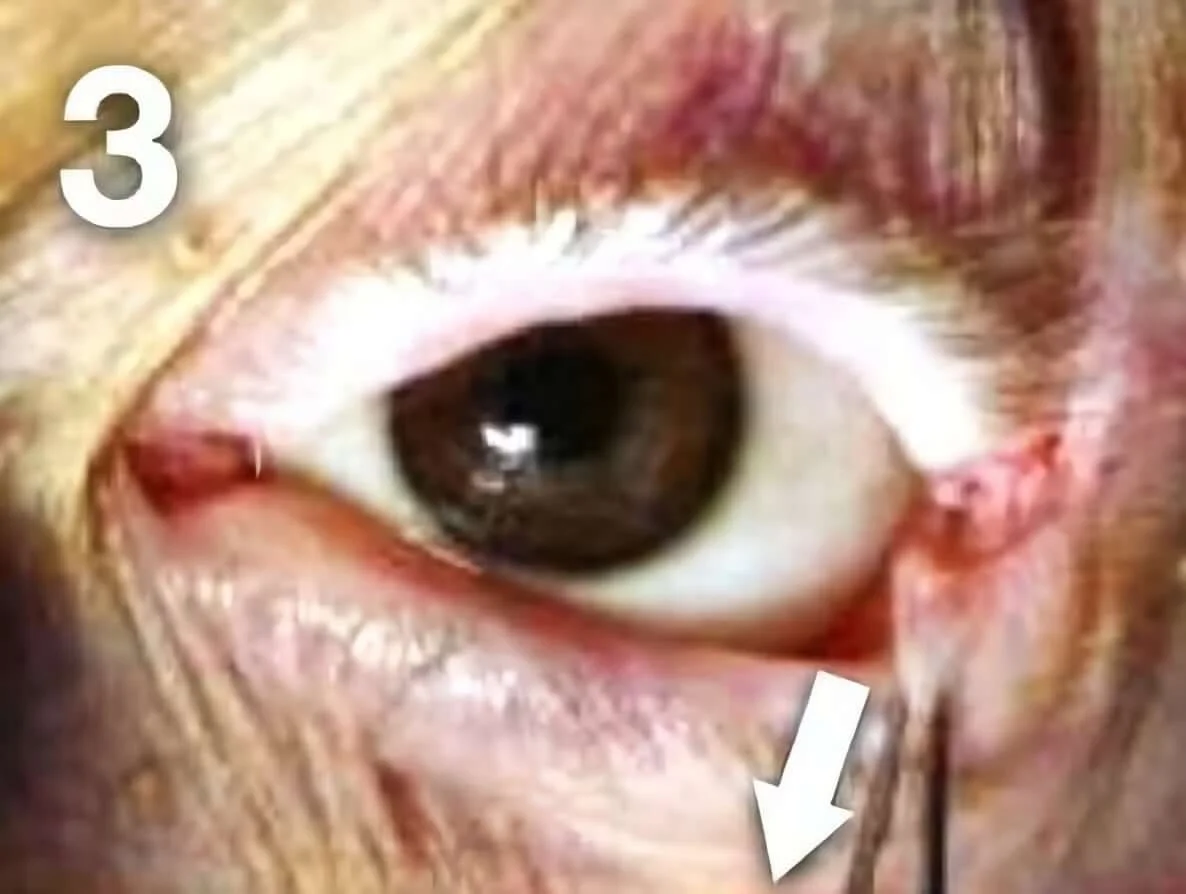 Resus Drills: Lateral Canthotomy — EM3