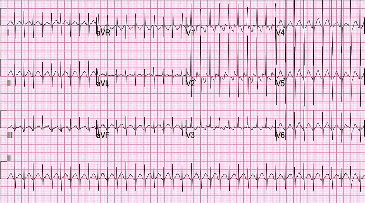Racing Hearts: a case of paediatric SVT — EM3