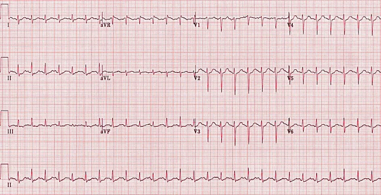 Racing Hearts: a case of paediatric SVT — EM3