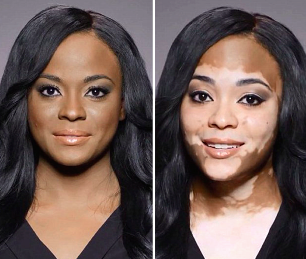 Vitiligo Makeup For Dark Skin | Saubhaya Makeup