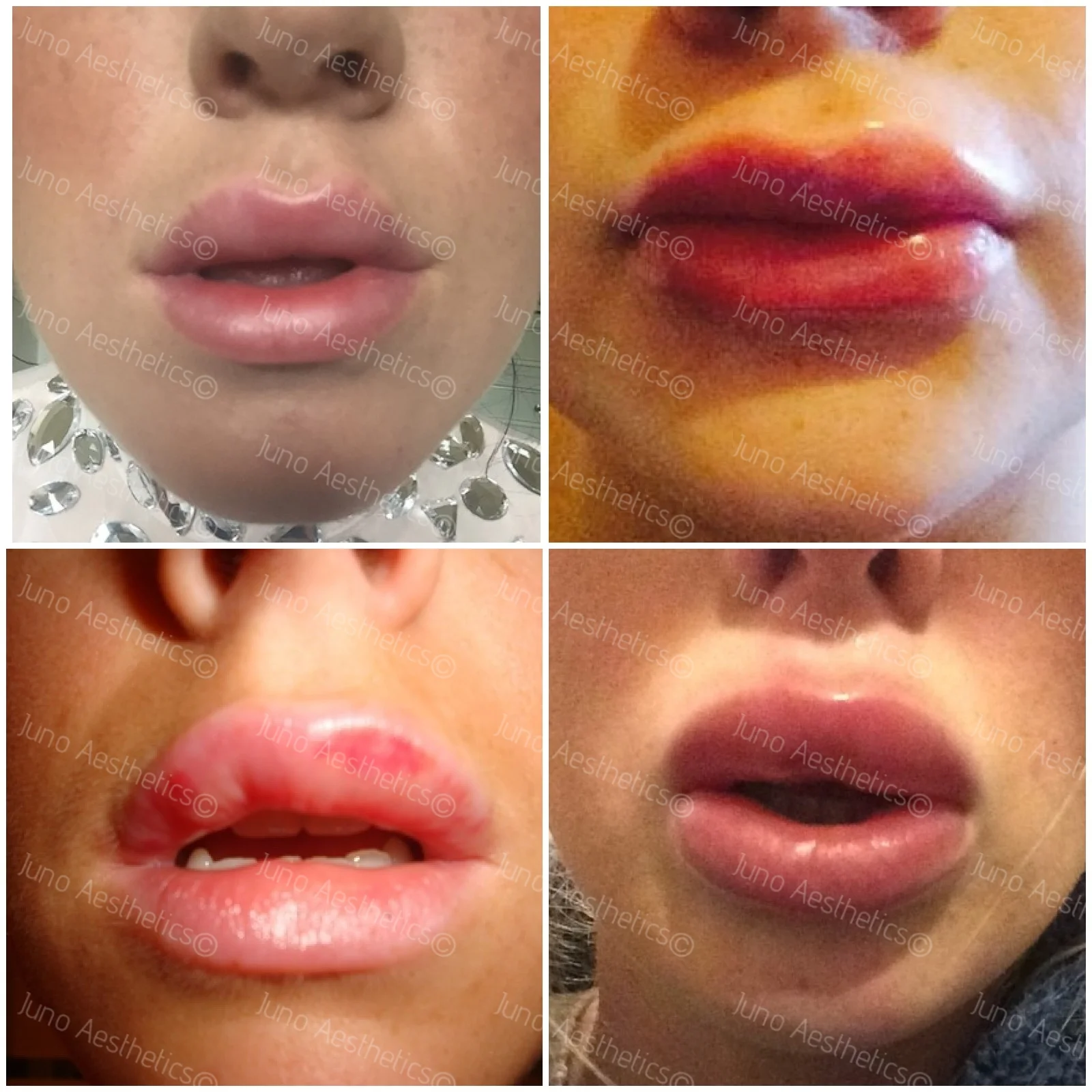 Lip Filler Blog Juno Medical Aesthetics