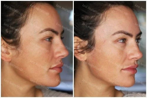 Lower Face — Juno Aesthetics