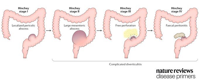 Divertículo, diverticulose e diverticulite - riscos e tratamento ...
