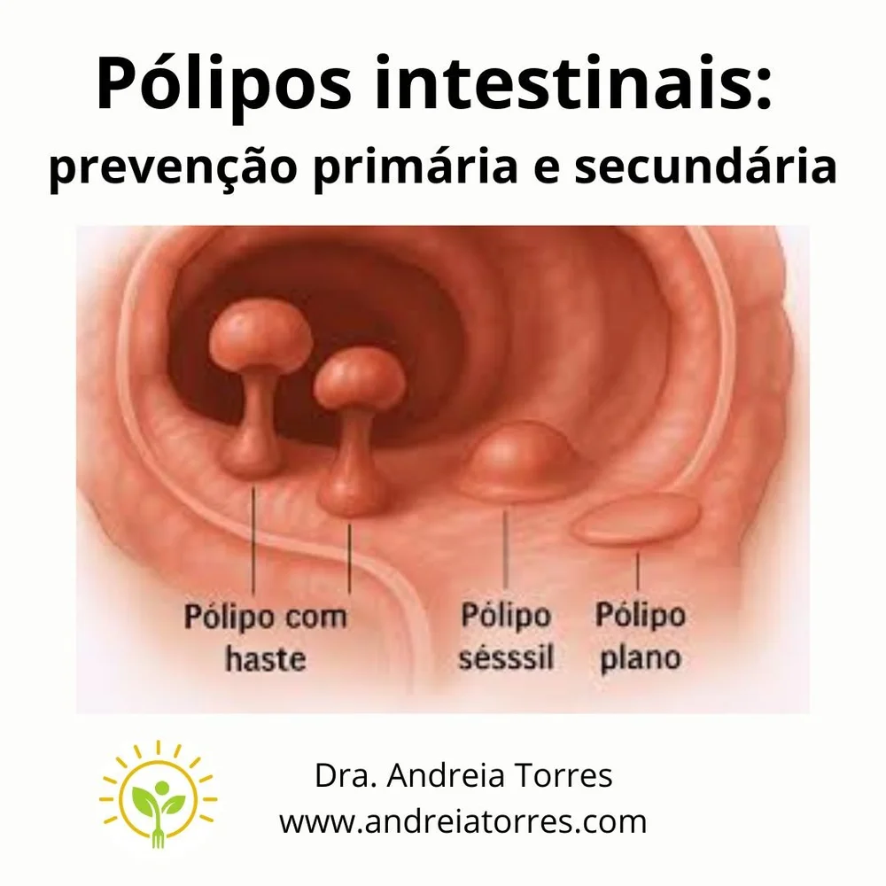 Pólipos intestinais: prevenção primária e secundária — ANDREIA TORRES