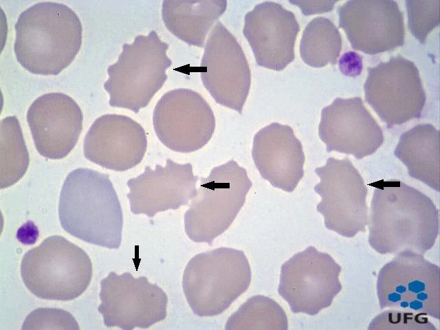Pesquisa de acantócitos no sangue — ANDREIA TORRES