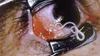 Loiasis — Drugs & Diagnostics for Tropical Diseases