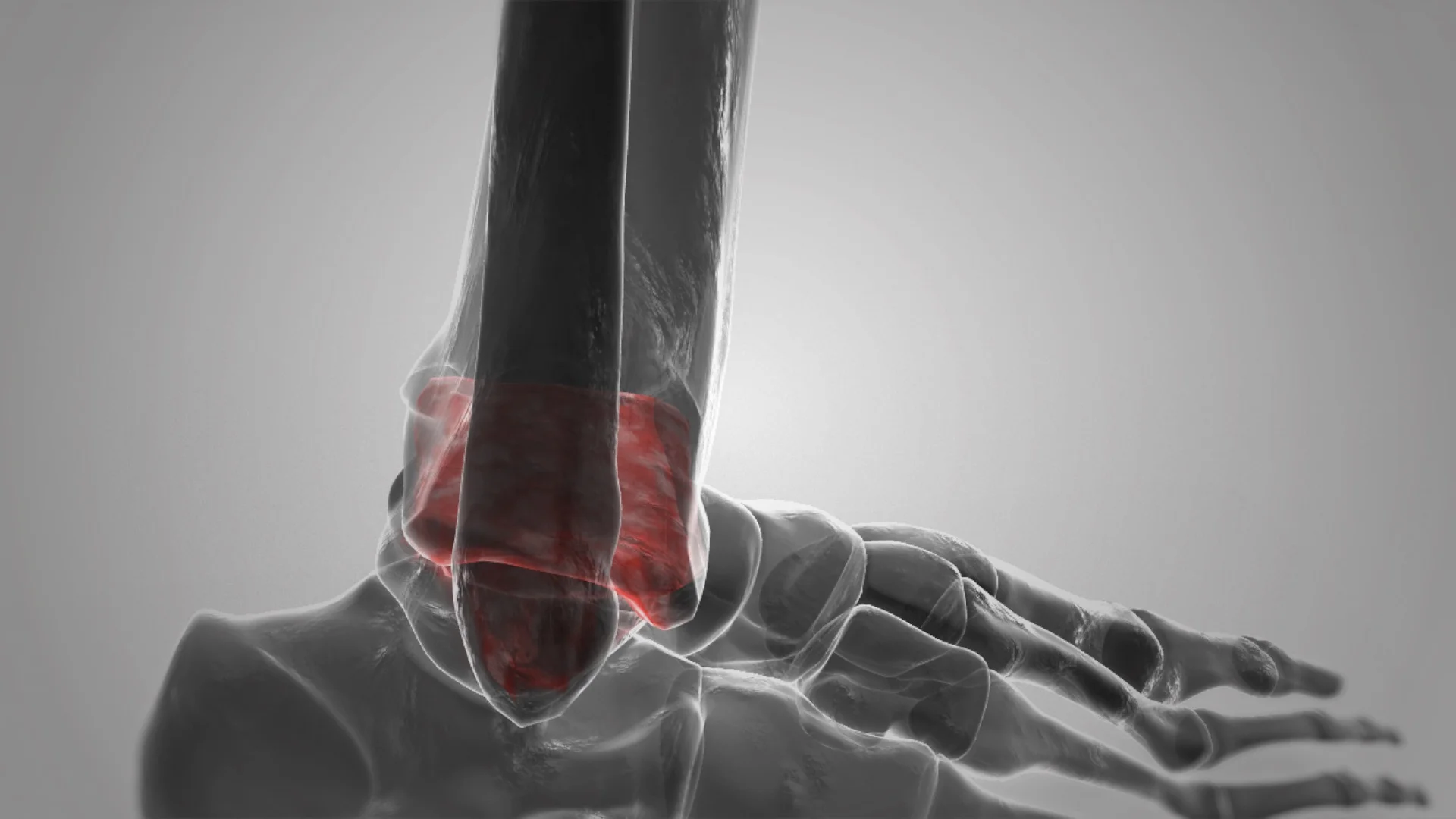 Ankle Replacement — Ankle Arthritis | Ankle Replacement | Arthrodesis ...