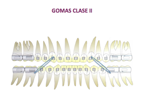 Elasticos intermaxilares — ORTODONCIA OJANGUREN