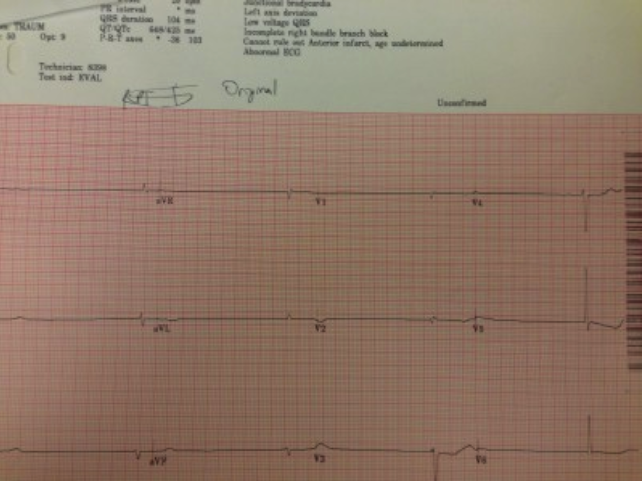 Beta Blocker Toxicity — NUEM Blog