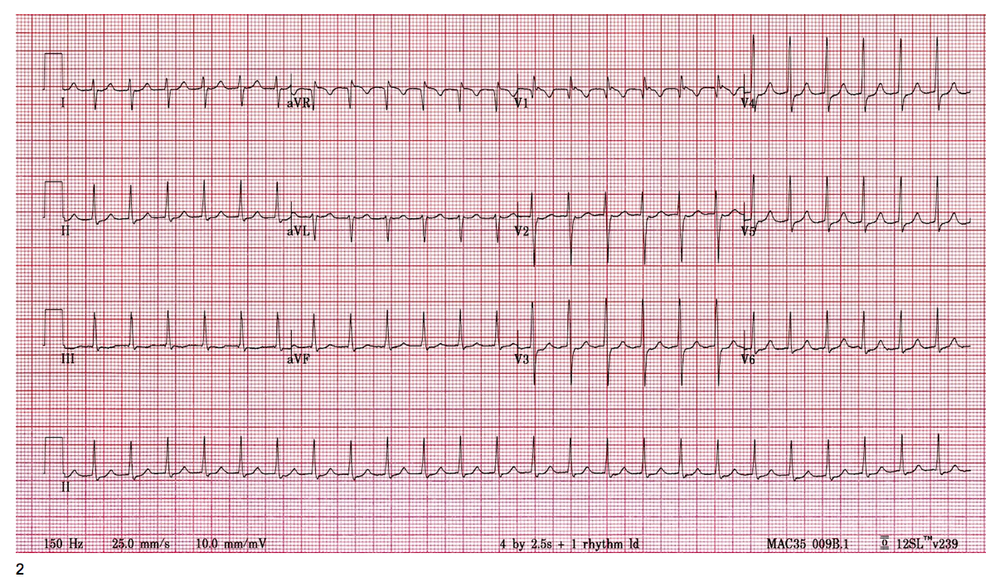 The New And Improved Valsalva: The Revert Trial — NUEM Blog