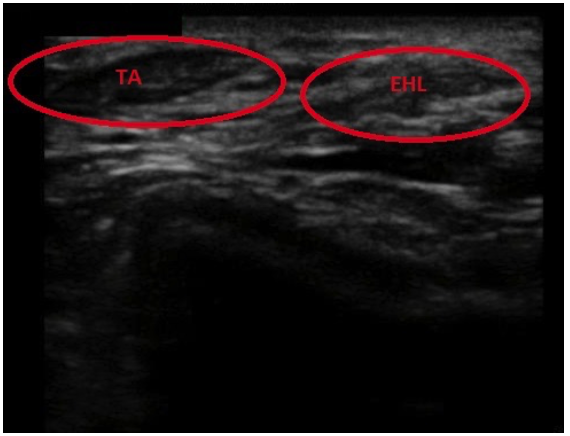 Owning The Ankle Arthrocentesis — NUEM Blog