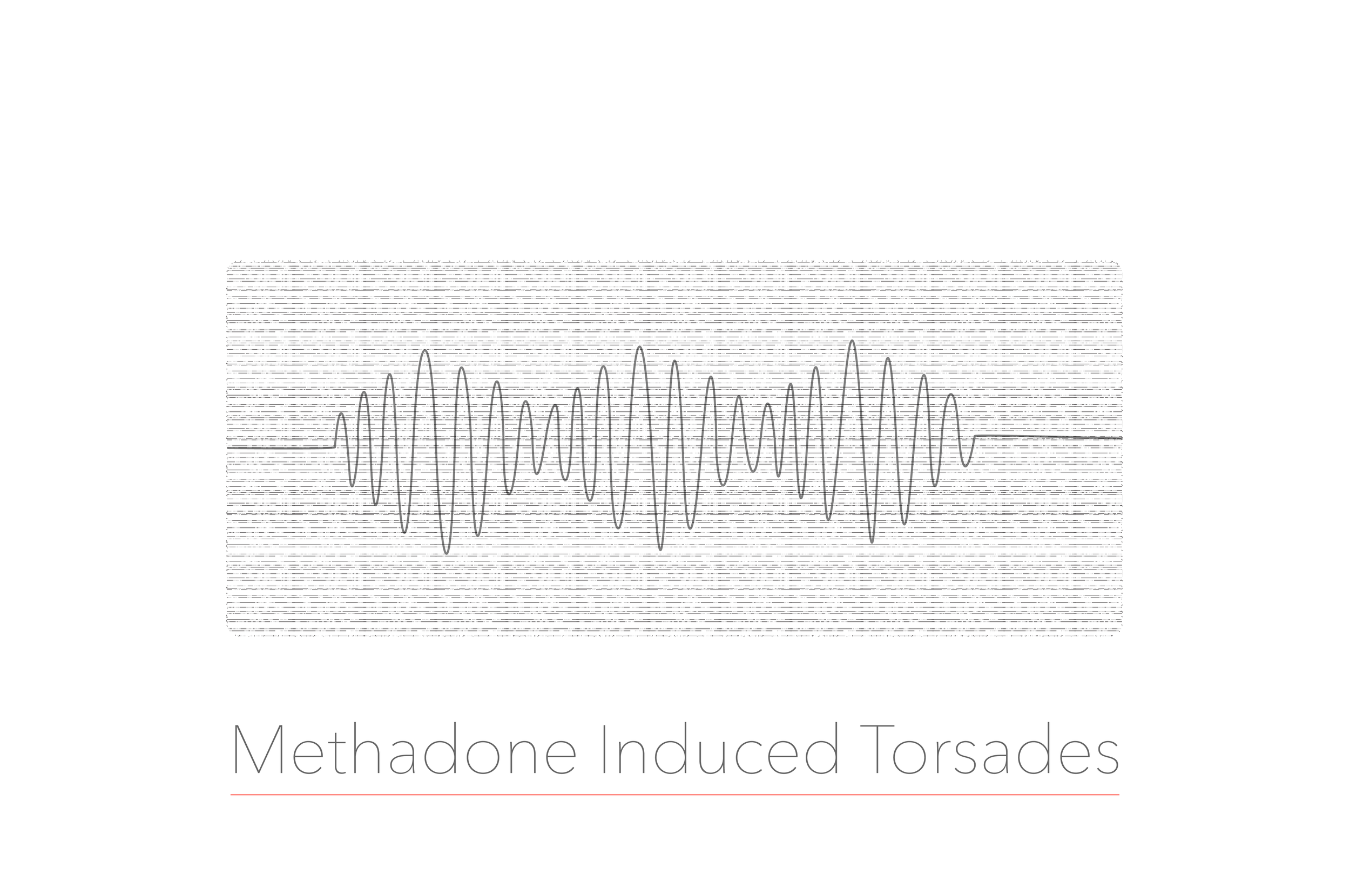 Methadone Induced Torsades — NUEM Blog