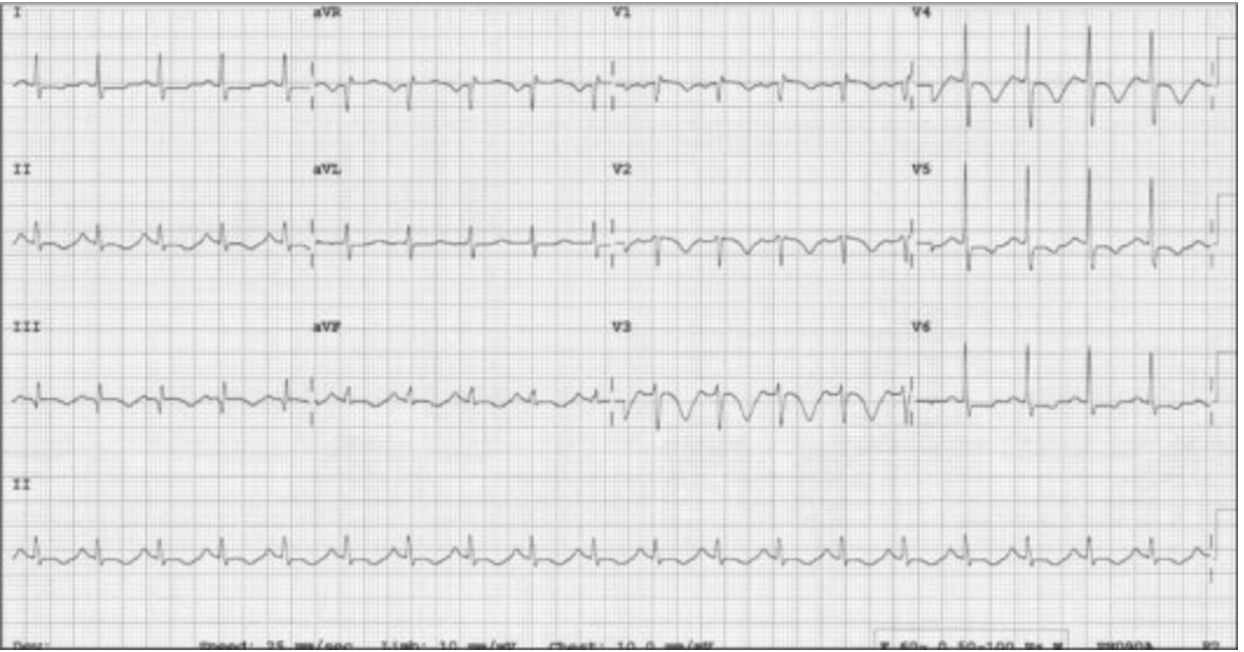 Pulmonary Embolism: Don't Throw Out That EKG! — NUEM Blog
