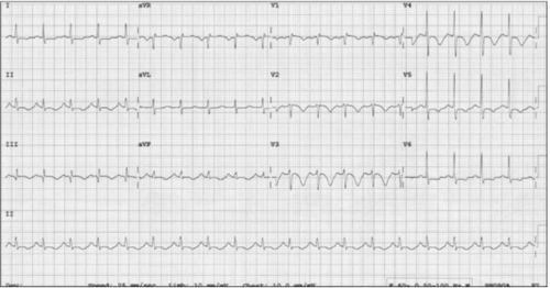 Pulmonary Embolism: Don't Throw Out That EKG! — NUEM Blog