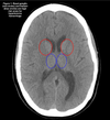 The ED Guide to Neuroimaging: Part 1 — NUEM Blog