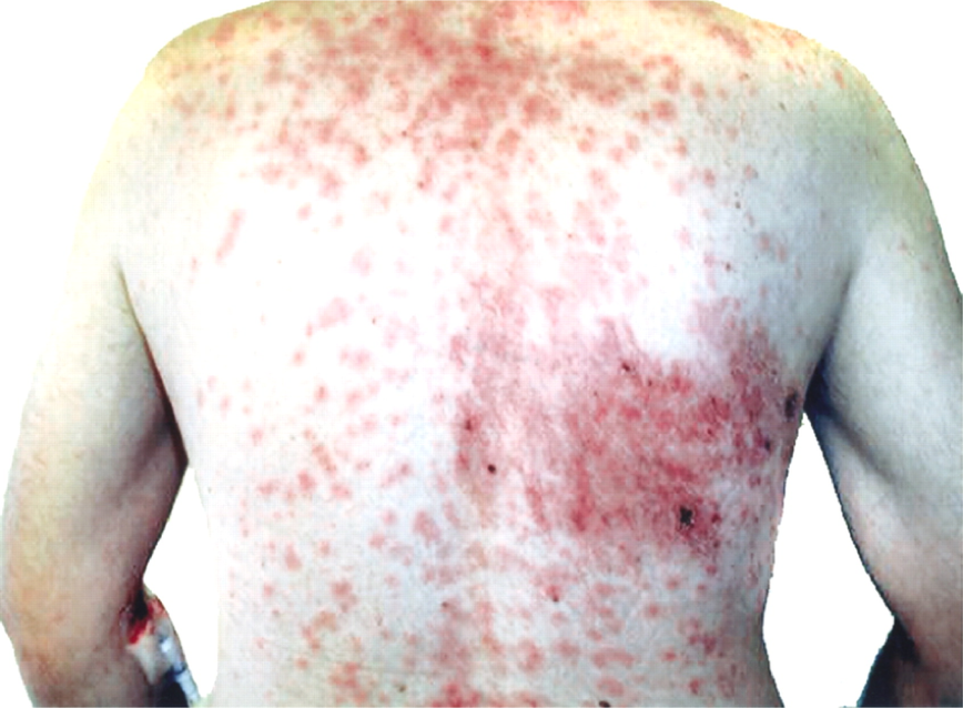 Herpes Zoster — NUEM Blog