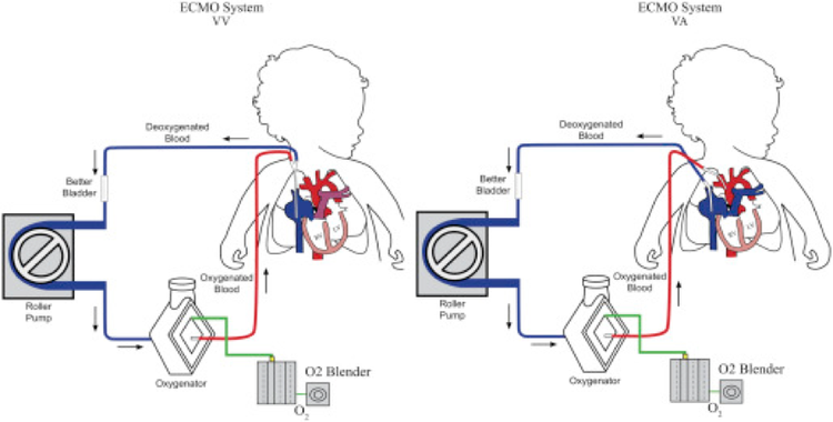 Pediatric ECMO: Beyond the Basics of Pediatric Resuscitation — NUEM Blog