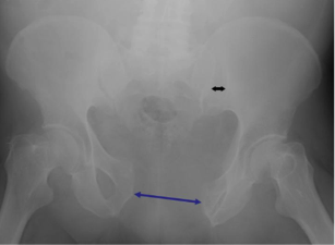 Pelvic Fractures — NUEM Blog