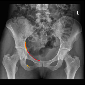 Pelvic Fractures — NUEM Blog
