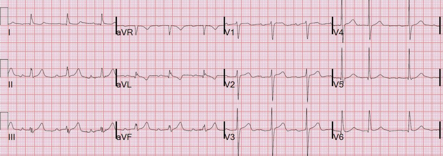 Don't Forget aVL! — NUEM Blog