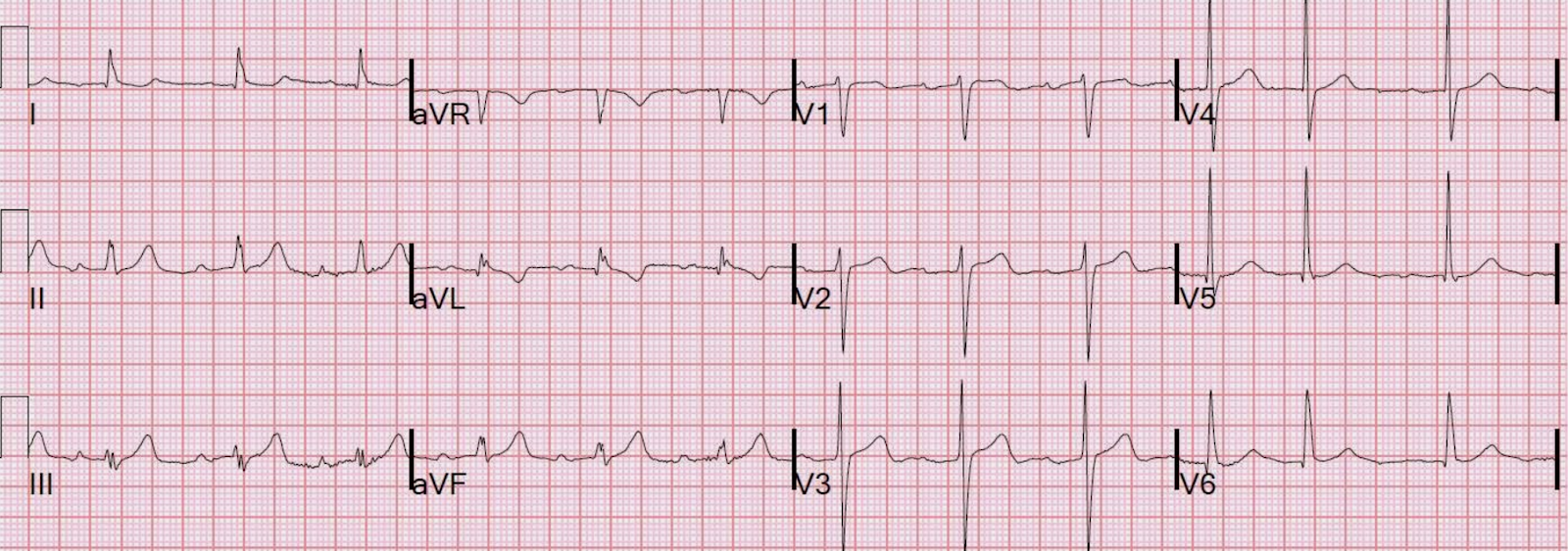 Don't Forget aVL! — NUEM Blog