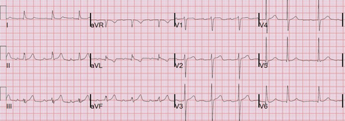 Don't Forget aVL! — NUEM Blog