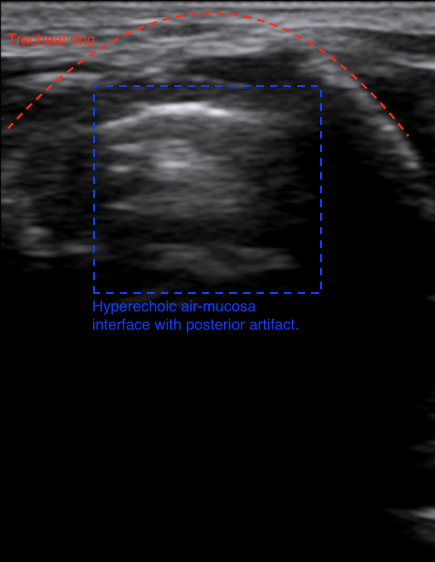 Ultrasound Confirmation of Endotracheal Tube Placement — NUEM Blog