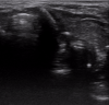 Ultrasound Confirmation of Endotracheal Tube Placement — NUEM Blog