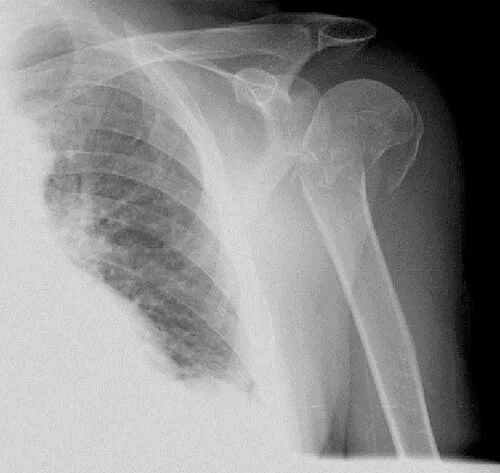 Shoulder pain after fall — NUEM Blog