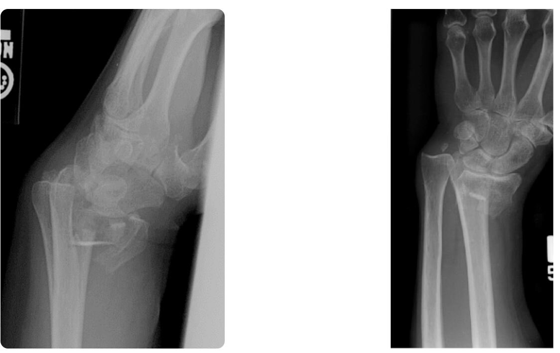 Fall on hand — NUEM Blog