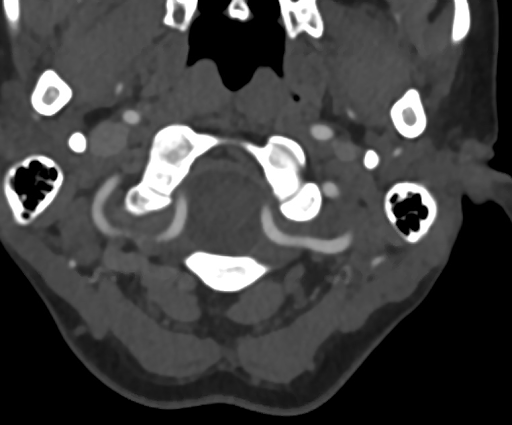 Emergency Guide to Stroke Neuroimaging — NUEM Blog