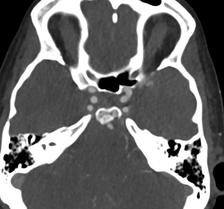 Emergency Guide to Stroke Neuroimaging — NUEM Blog