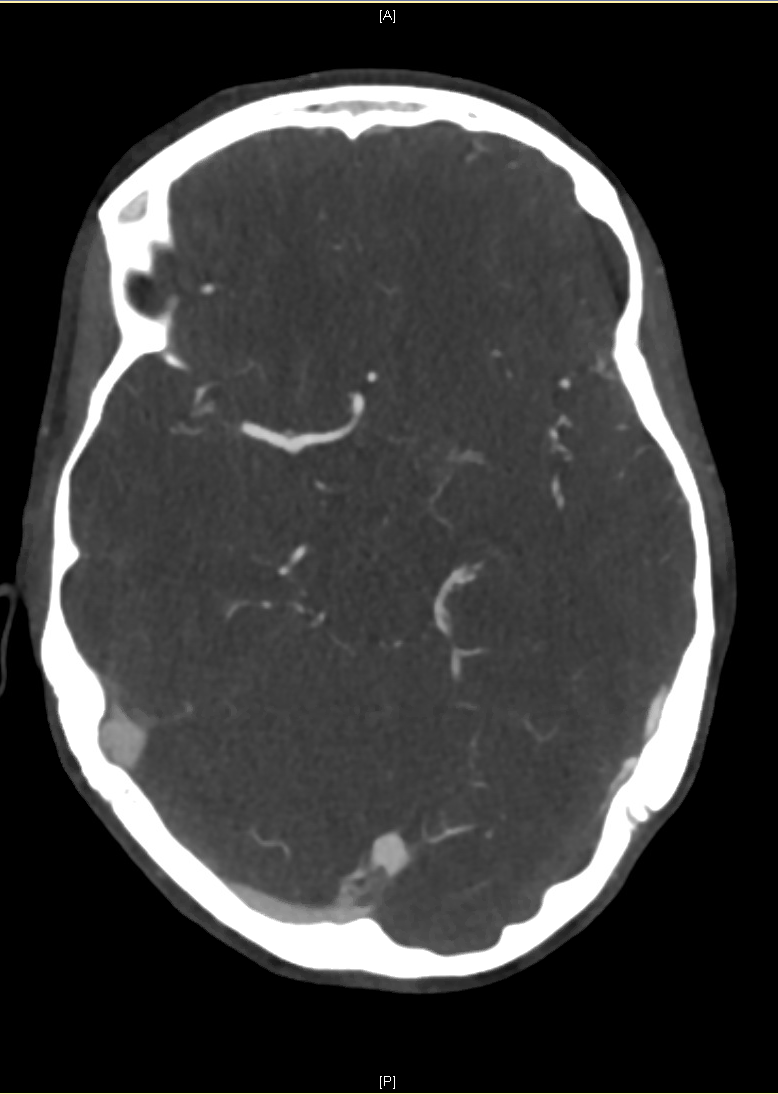 Emergency Guide to Stroke Neuroimaging — NUEM Blog