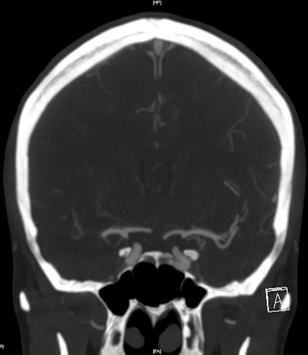 Emergency Guide to Stroke Neuroimaging — NUEM Blog