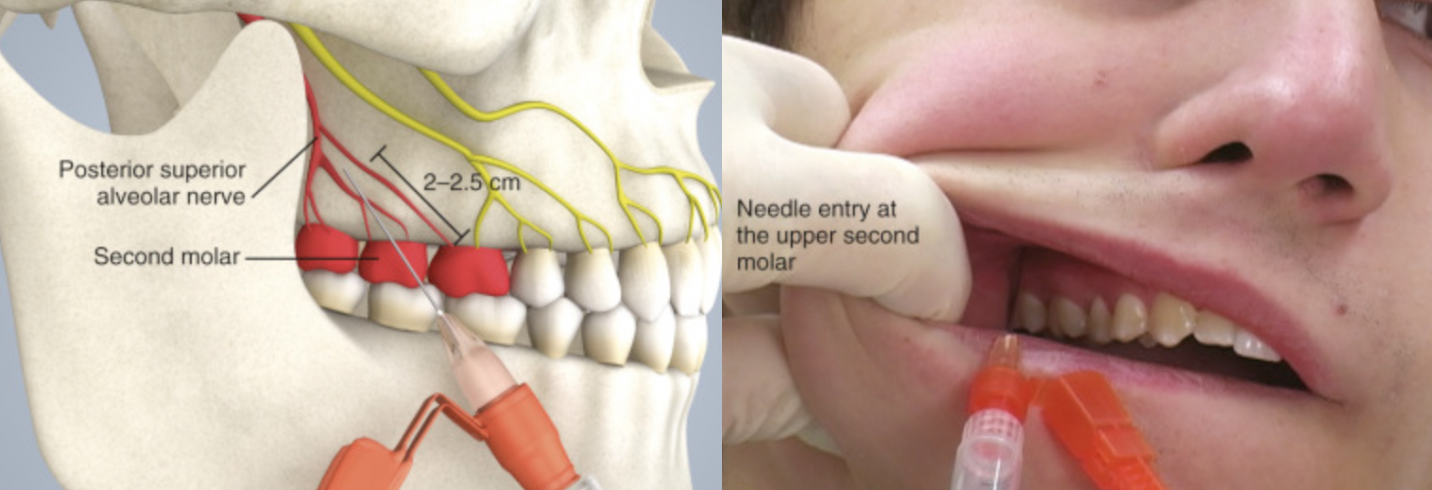 Posterior Superior Alveolar Nerve Block