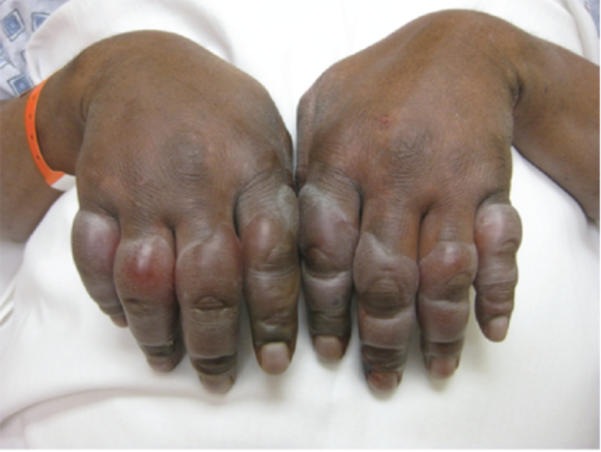 Cold Injury Management in the ED — NUEM Blog