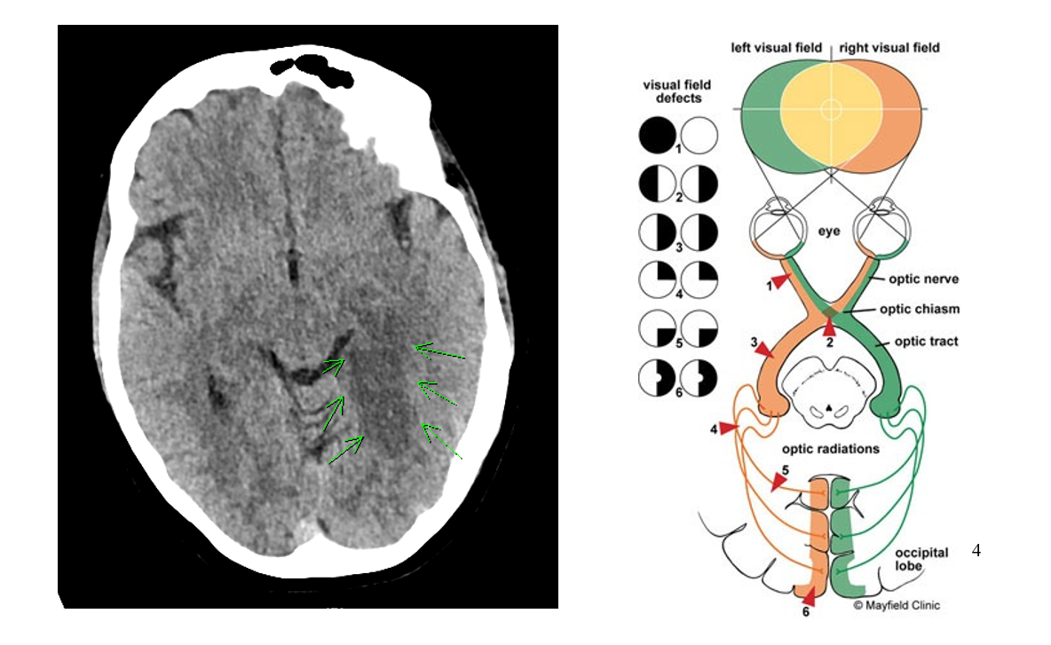 Non Contrast CT Head for the EM Physician — NUEM Blog