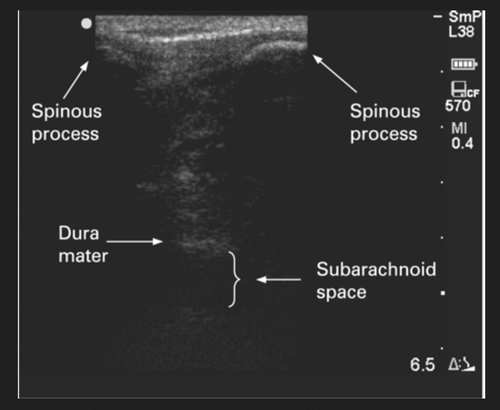 Ultrasound Guidance for Lumbar Puncture — NUEM Blog