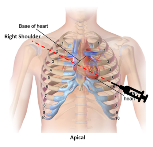 Pericardiocentesis — NUEM Blog