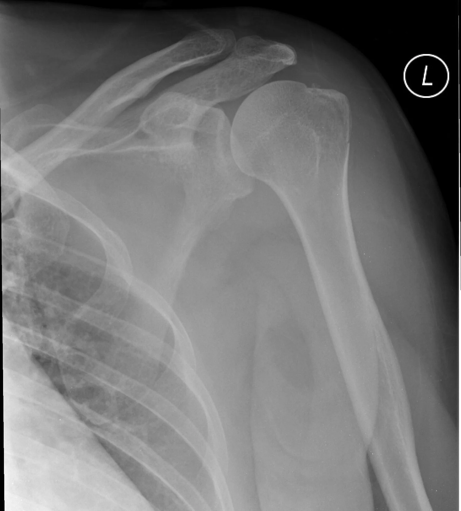 shoulder — Ortho Teaching Files — NUEM Blog