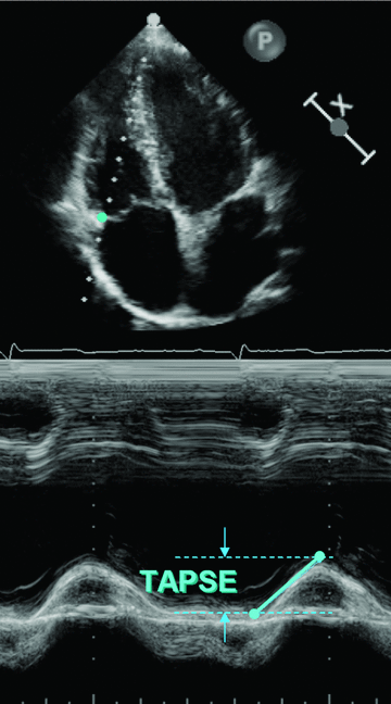 SonoPro Tips and Tricks for Pulmonary Embolism — NUEM Blog