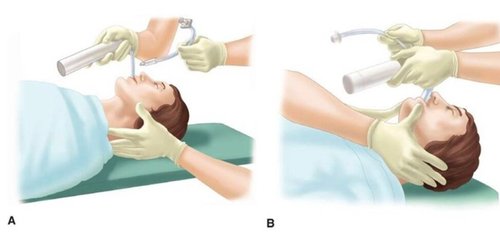C-Spine Intubation — NUEM Blog