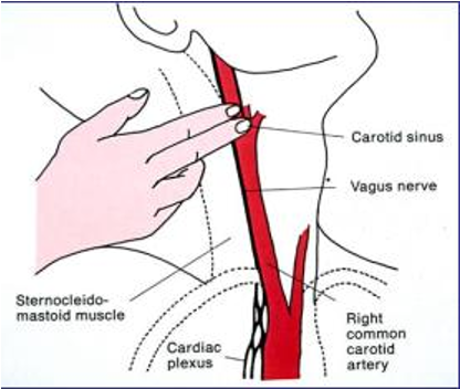 Vagal Maneuvers Simplified — NUEM Blog