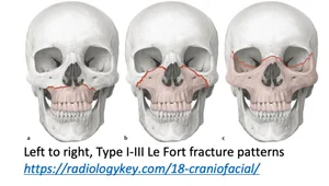 Facial Fractures: Midface and Mandible — NUEM Blog
