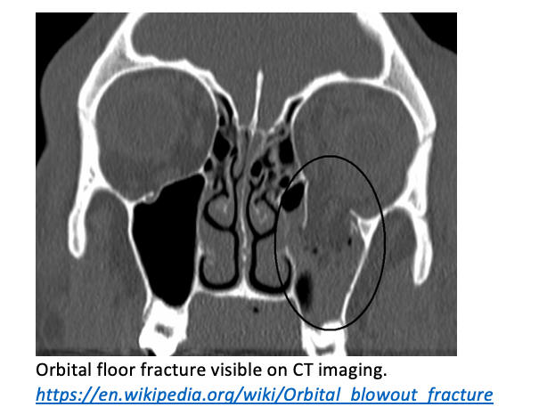 Facial Fractures: Frontal Bone and Orbit — NUEM Blog