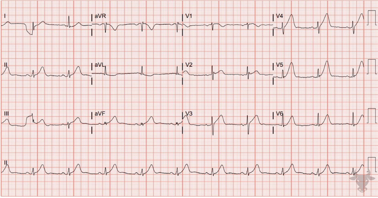 STEMI to OMI: Rethinking who will benefit from PCI — NUEM Blog